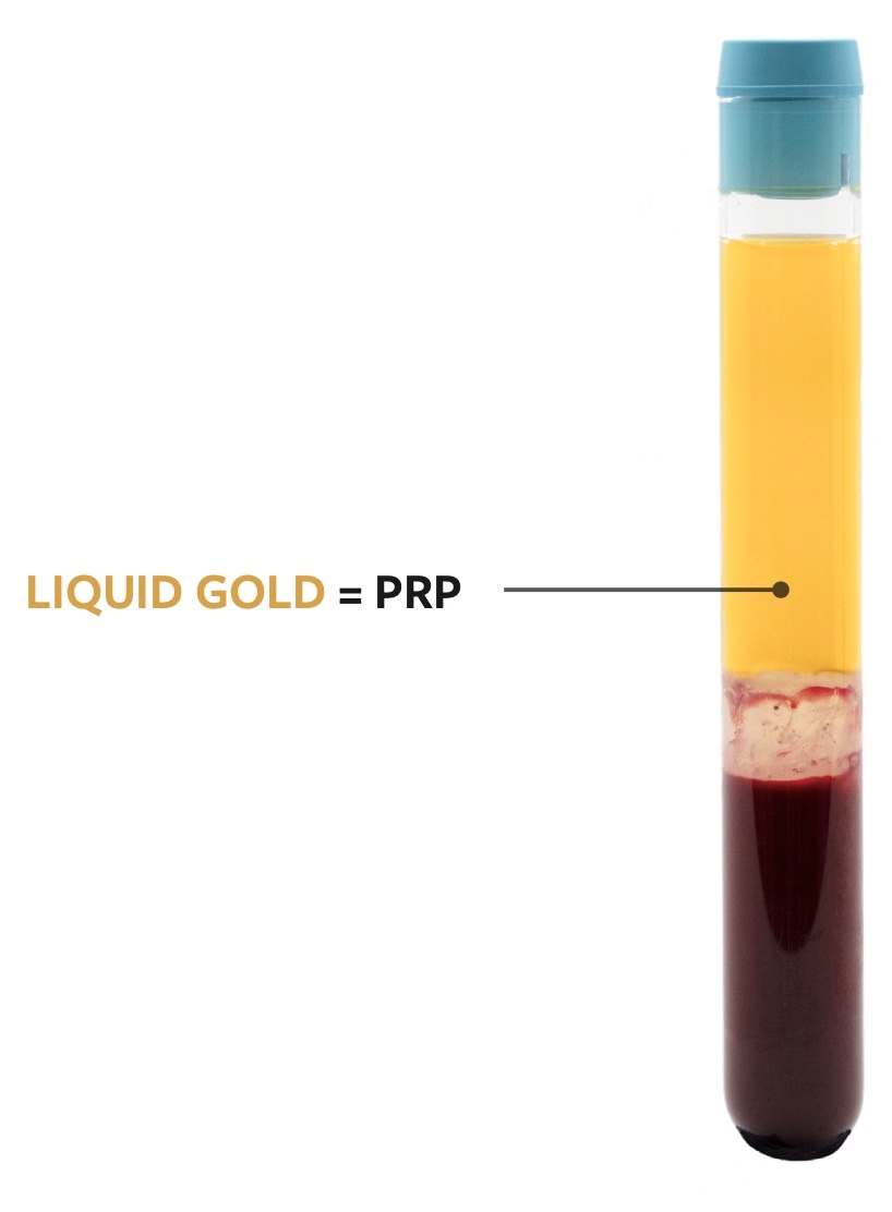 Gold Rush PRP - Top Shelf Orthopedics